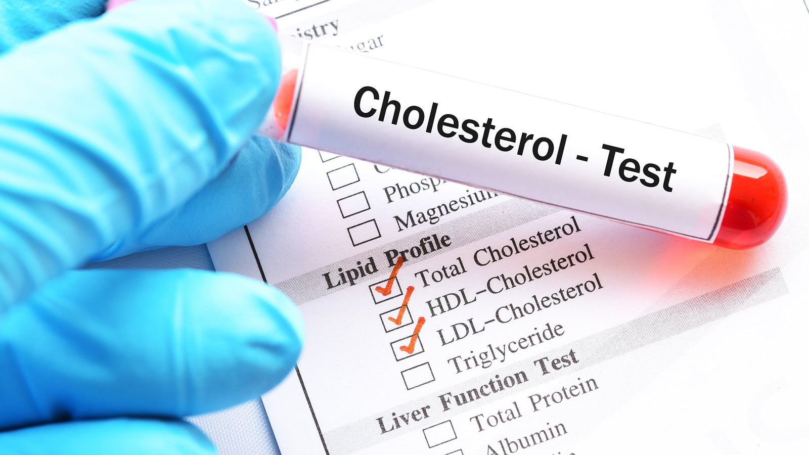 Cholesterol Test: What Is It and How to Prepare in 7 Steps?